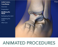 Kidner Procedure | Princeton | New Jersey | Monroe Township