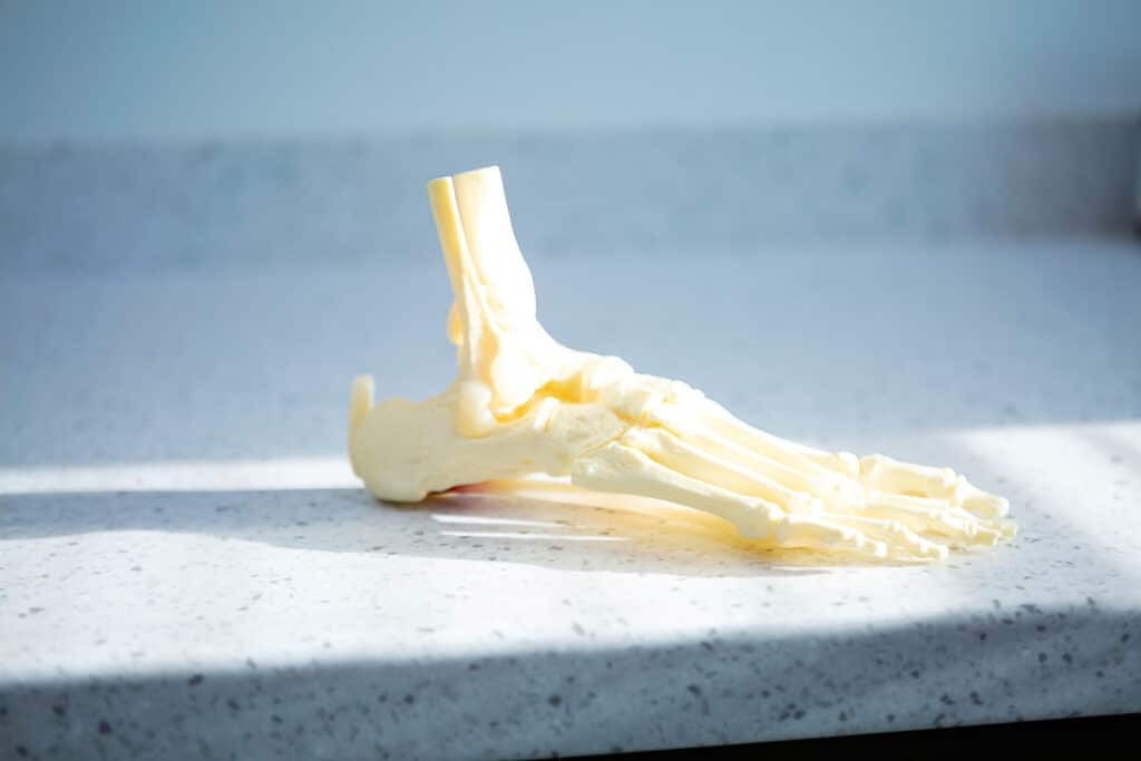 What is The Kidner Procedure - Lasting Foot Pain Relief - Princeton ...