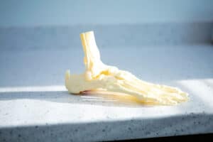 What is The Kidner Procedure - Lasting Foot Pain Relief - Princeton ...