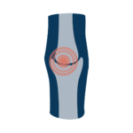 Understanding Bone Spurs: Symptoms, Causes, and Treatments - Princeton ...