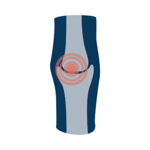 Understanding Bone Spurs: Symptoms, Causes, and Treatments - Princeton ...