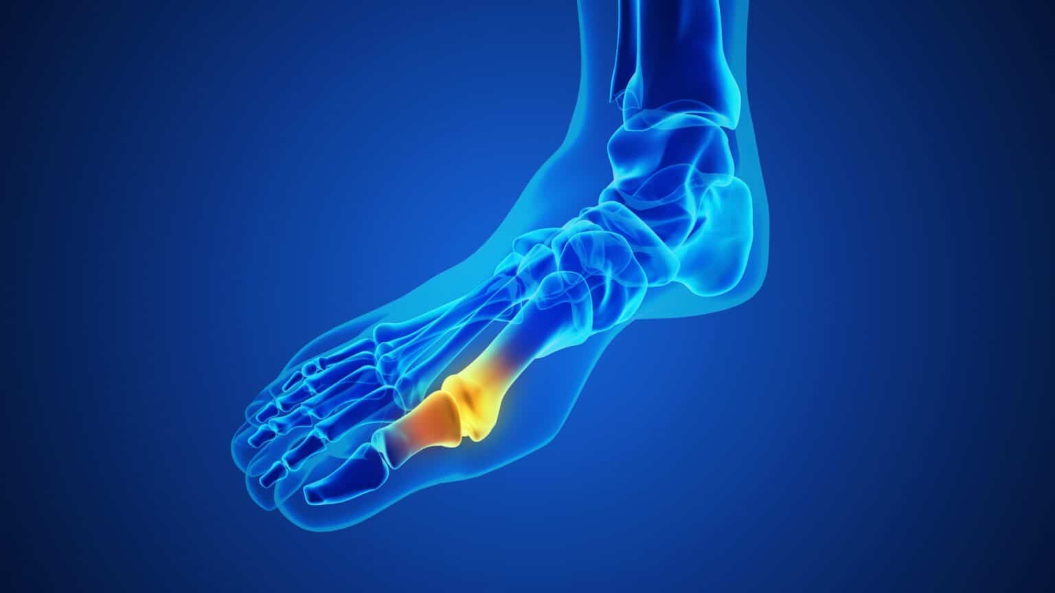 Gout: Symptoms, Risks, Diagnosis, and Treatment Guide - Princeton ...