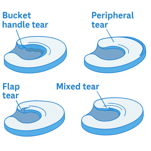 Meniscus Tears and Arthroscopic Surgery - Princeton Orthopaedic Associates